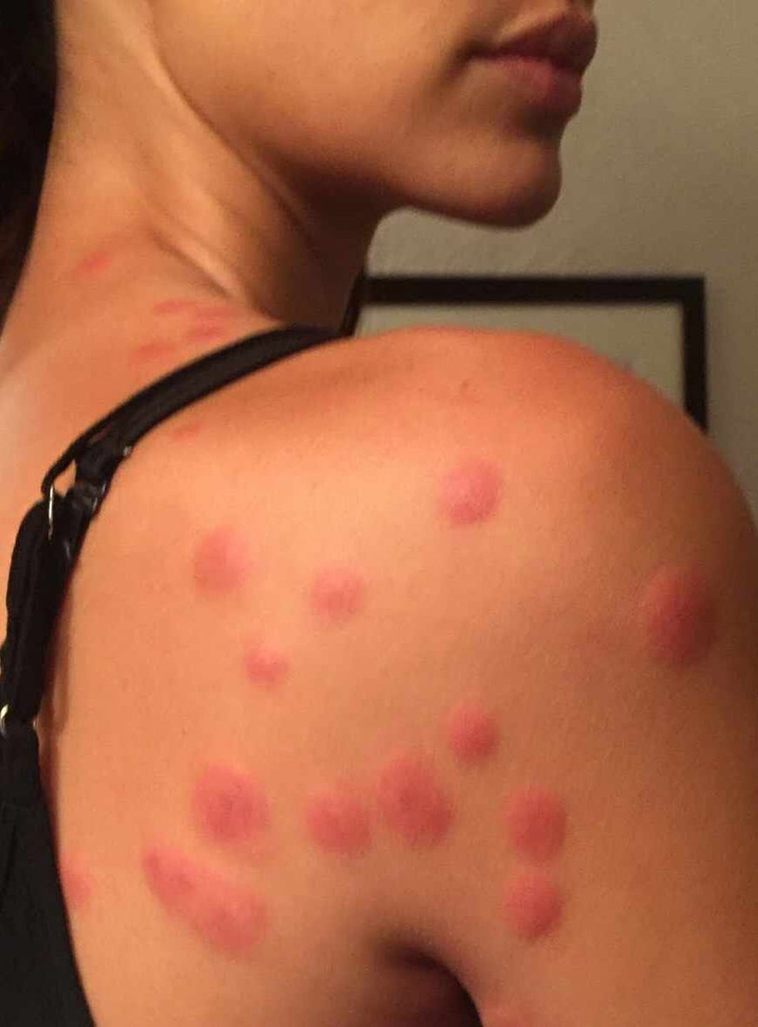 A Model Is Suing a Hotel After Bed Bug 'Massacre' - The Points Guy
